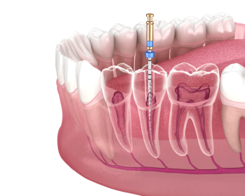 Endodontsko liječenje upale zubnog živca - Spalato Dental - stomatolog ...